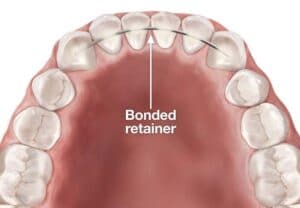 What Are Permanent Retainers and How Do They Work? — Orthodontic ...